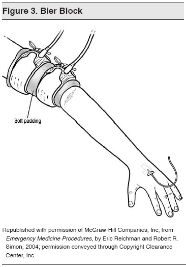 Intravenous Regional Anesthesia Bier Block